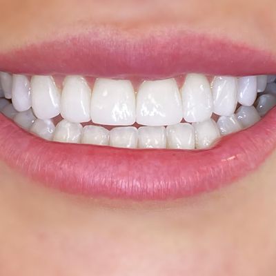 Dental Cosmetic Bonding | Tooth Bonding // 3Dental In Dublin, Limerick ...