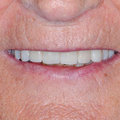 Prosthodontic Treatments | Dental Prostheses // 3Dental In Dublin ...