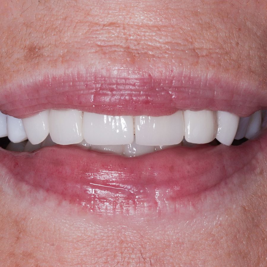 Composite Bonding Vs Veneers