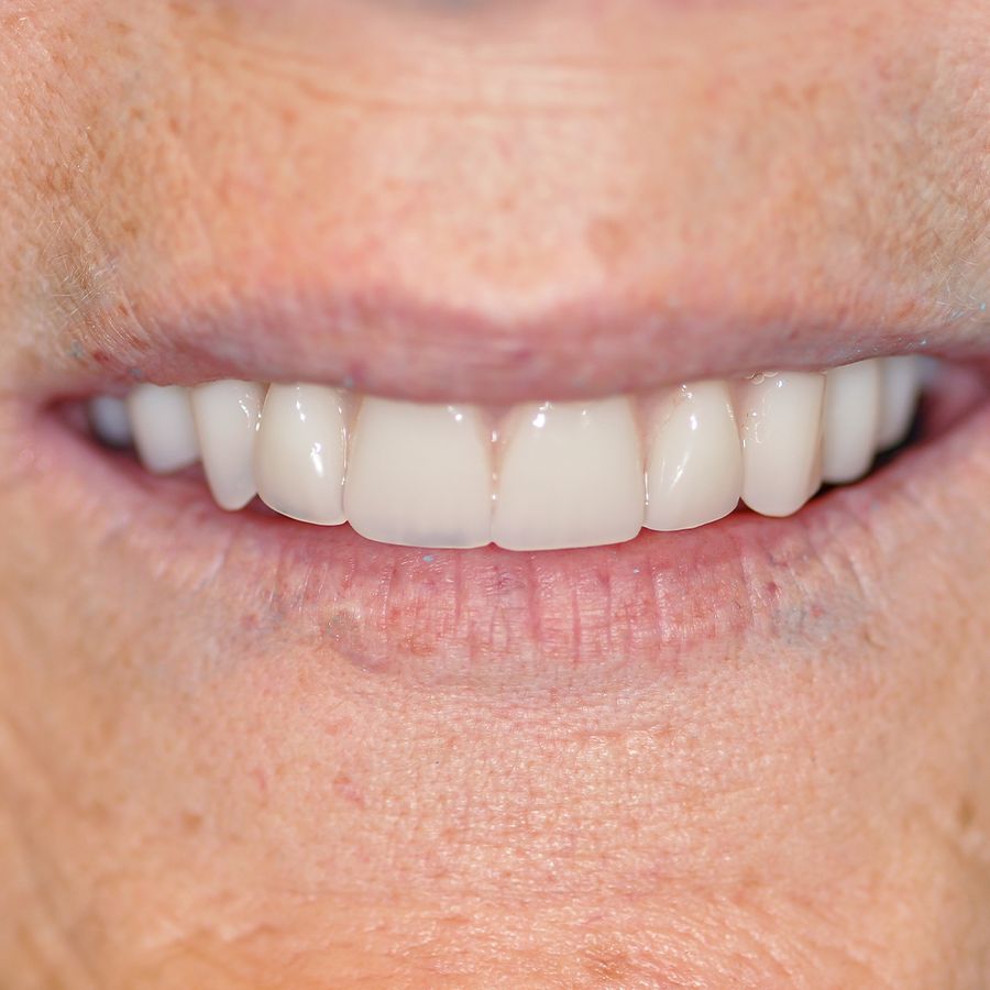 Malocclusion of Teeth - Diagnosis and Orthodontic Treatment