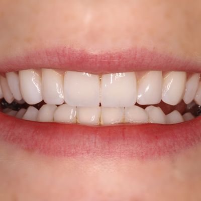 Dental Cosmetic Bonding | Tooth Bonding // 3Dental In Dublin, Limerick ...