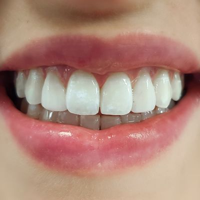 Dental Cosmetic Bonding | Tooth Bonding // 3Dental In Dublin, Limerick ...