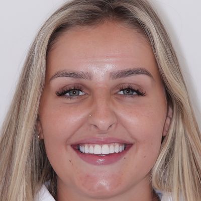 Train Track Braces | Fixed Orthodontic Appliances // 3Dental In Dublin ...