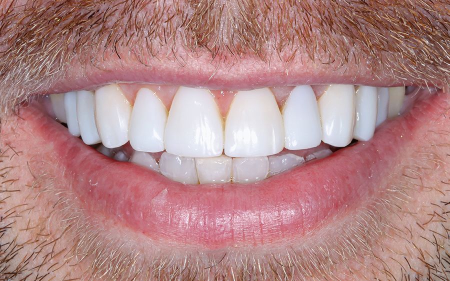 Malocclusion of Teeth - Diagnosis and Orthodontic Treatment