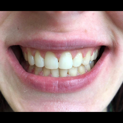Gingivectomy Procedure | Gum Dental Surgery // 3Dental