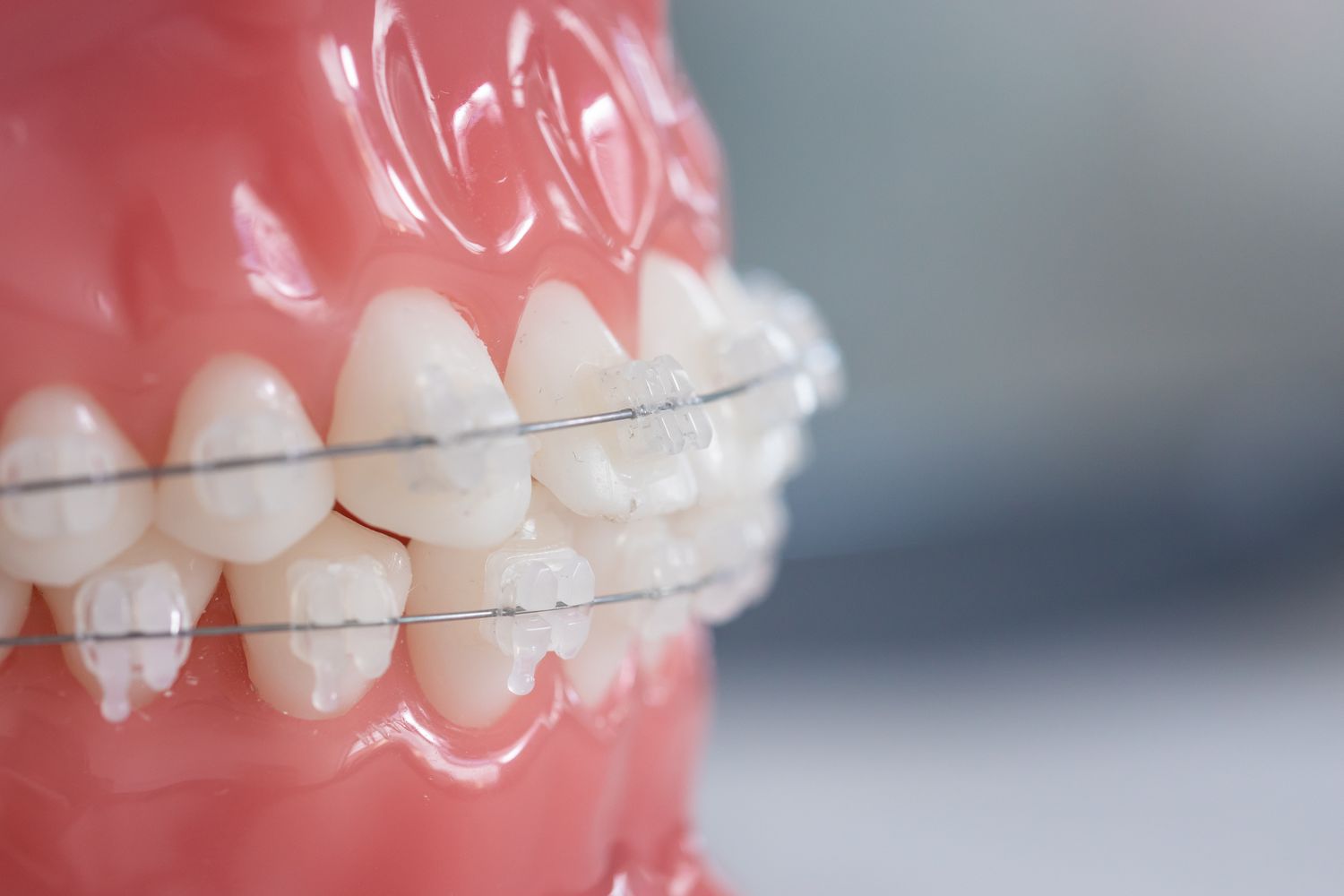 Orthdontic Event Limerick | Invisalign & Adult Braces