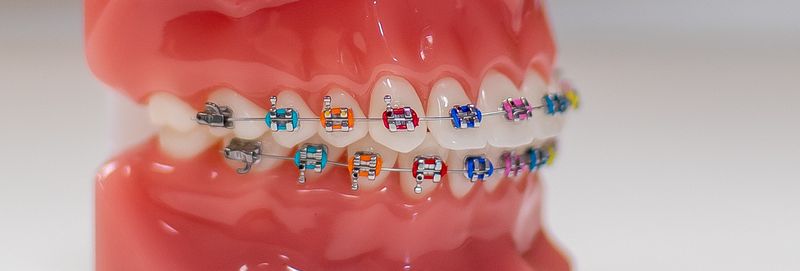 Coloured Braces | Brighten Up Your Smile! // 3Dental In Dublin ...