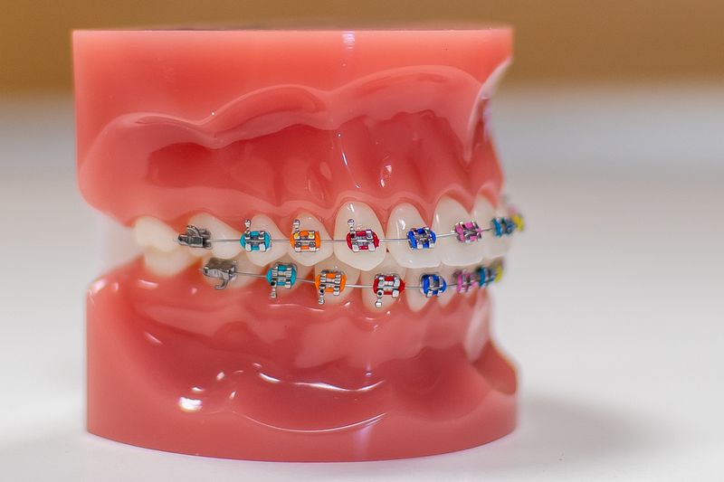 Coloured Braces | Brighten Up Your Smile! // 3Dental In Dublin ...