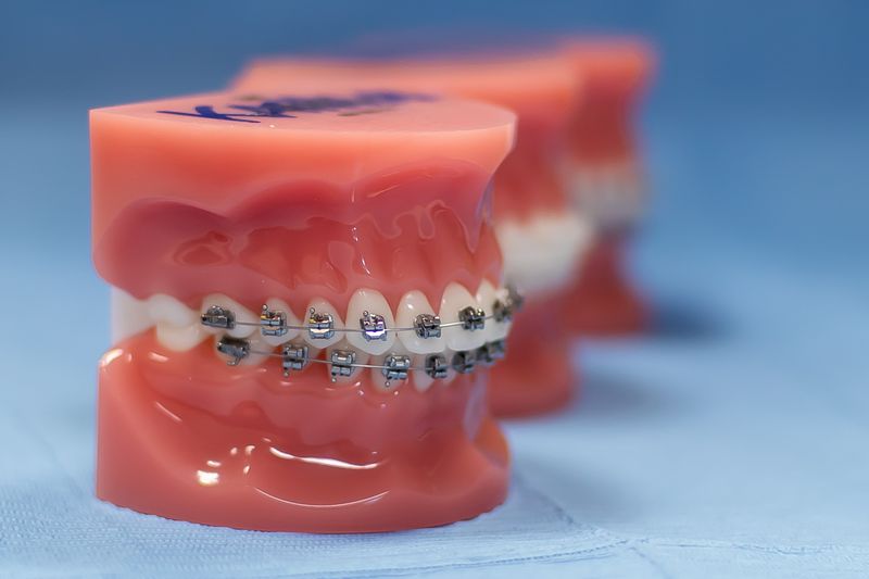 Train Track Braces | Fixed Orthodontic Appliances // 3Dental In Dublin ...