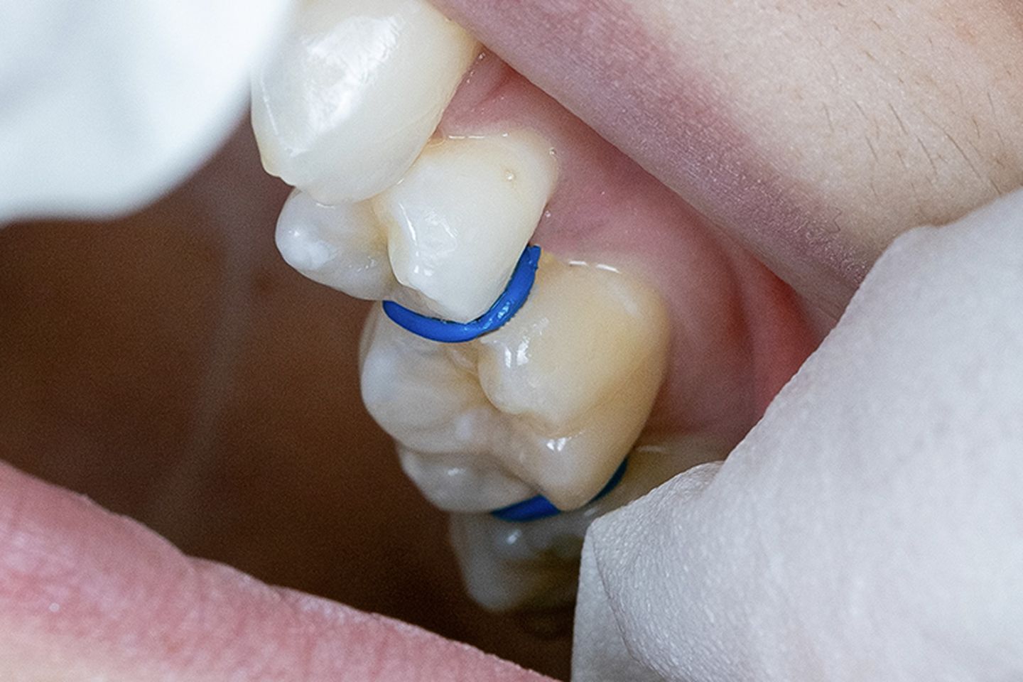 Everything You Need To Know About Orthodontic Spacers