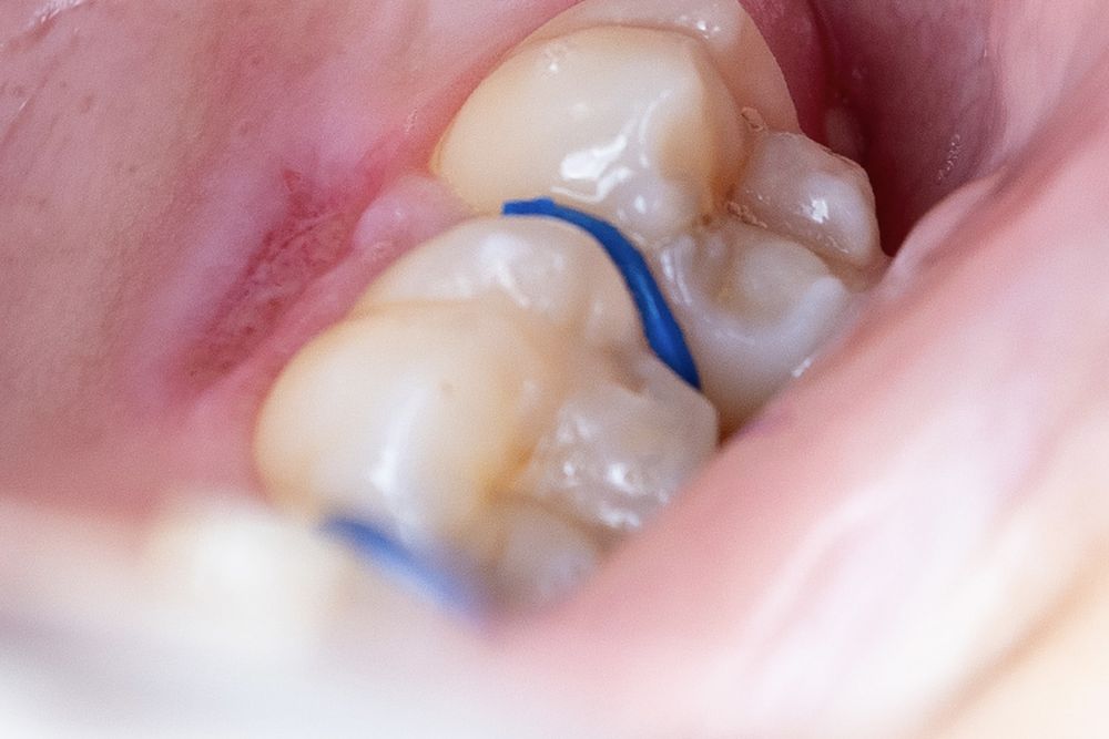 Everything You Need To Know About Orthodontic Spacers